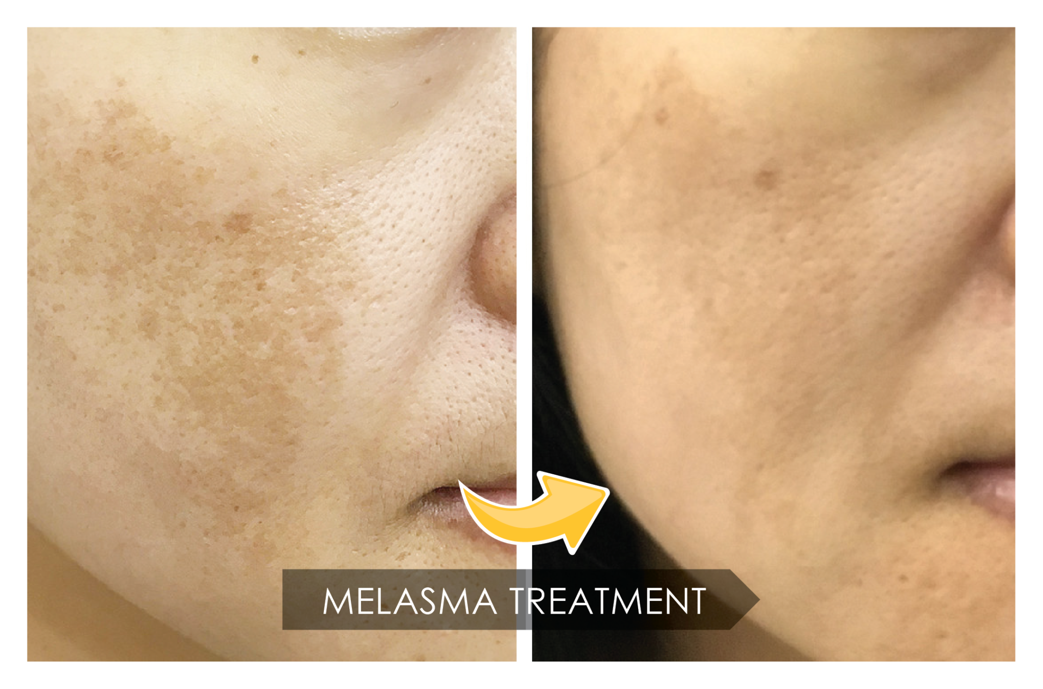 Before & After - UR Klinik | Skin Pigmentation Treatment Malaysia