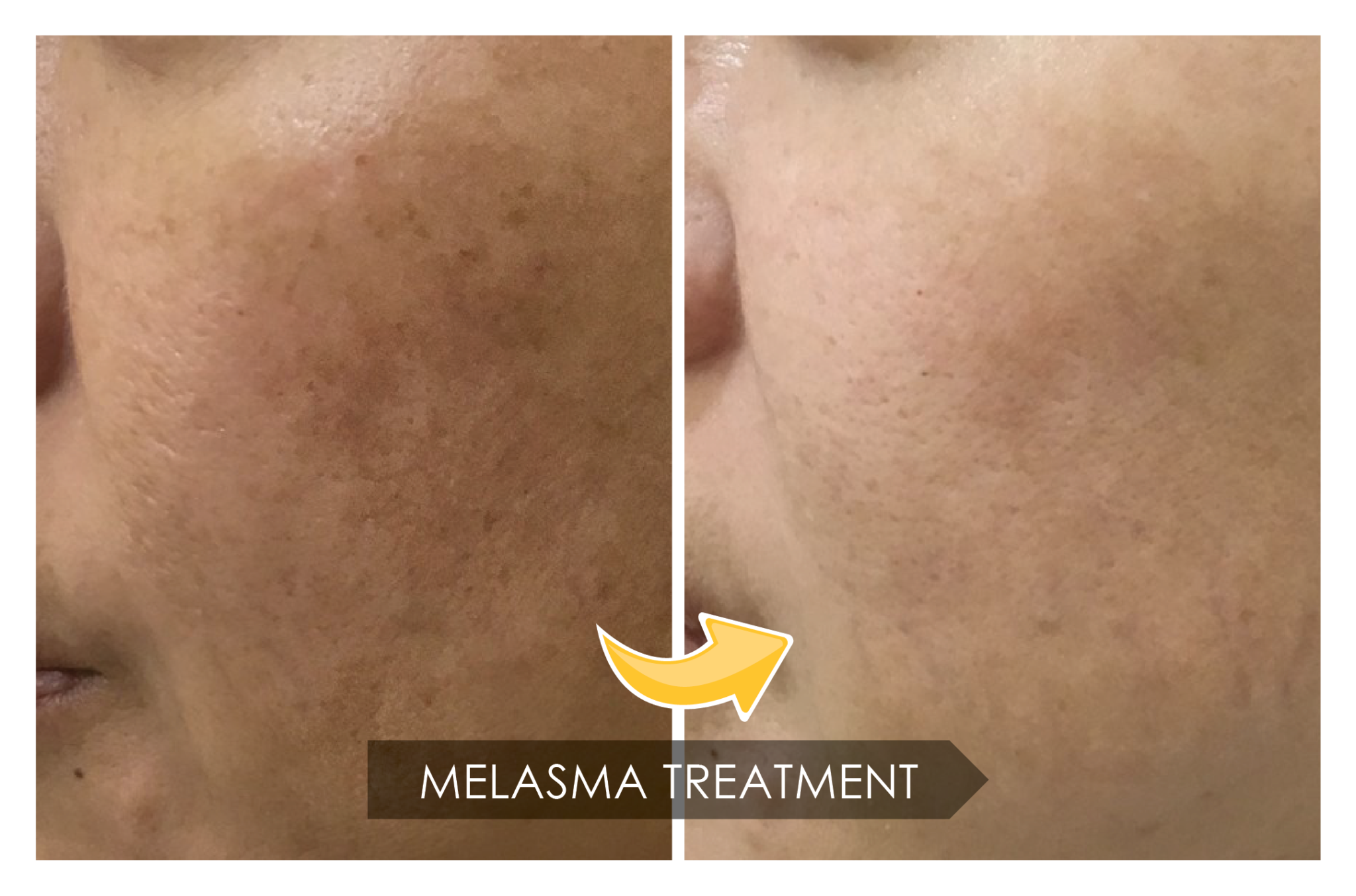 Before & After - UR Klinik | Skin Pigmentation Treatment Malaysia