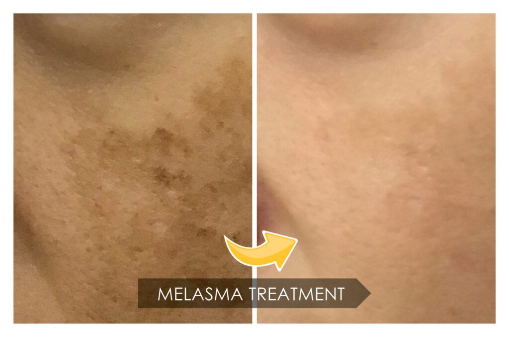 Before & After - UR Klinik | Skin Pigmentation Treatment Malaysia