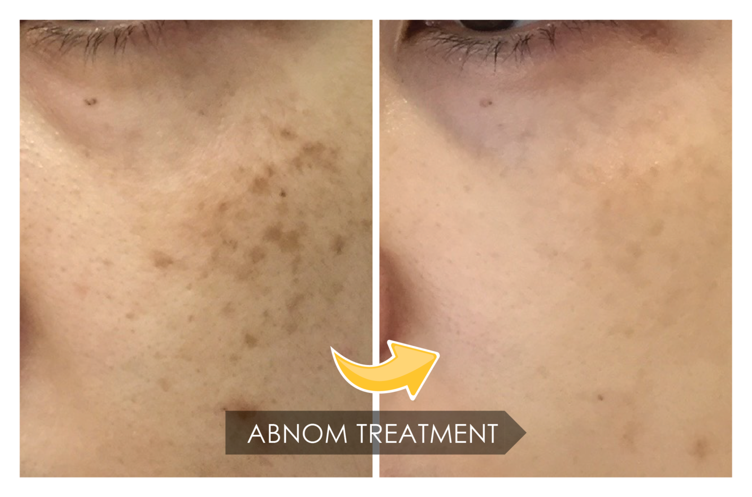 Before & After - UR Klinik | Skin Pigmentation Treatment Malaysia