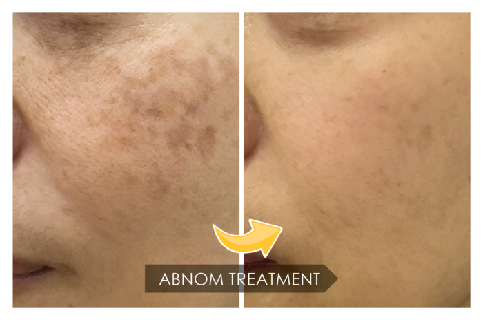 Before & After - UR Klinik | Skin Pigmentation Treatment Malaysia