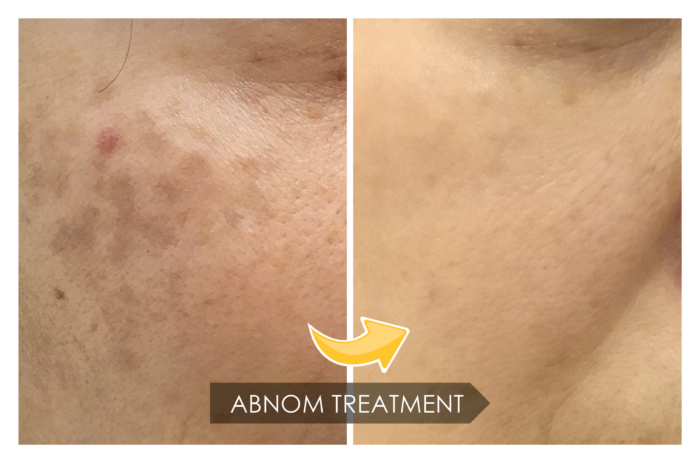 Before & After - UR Klinik | Skin Pigmentation Treatment Malaysia