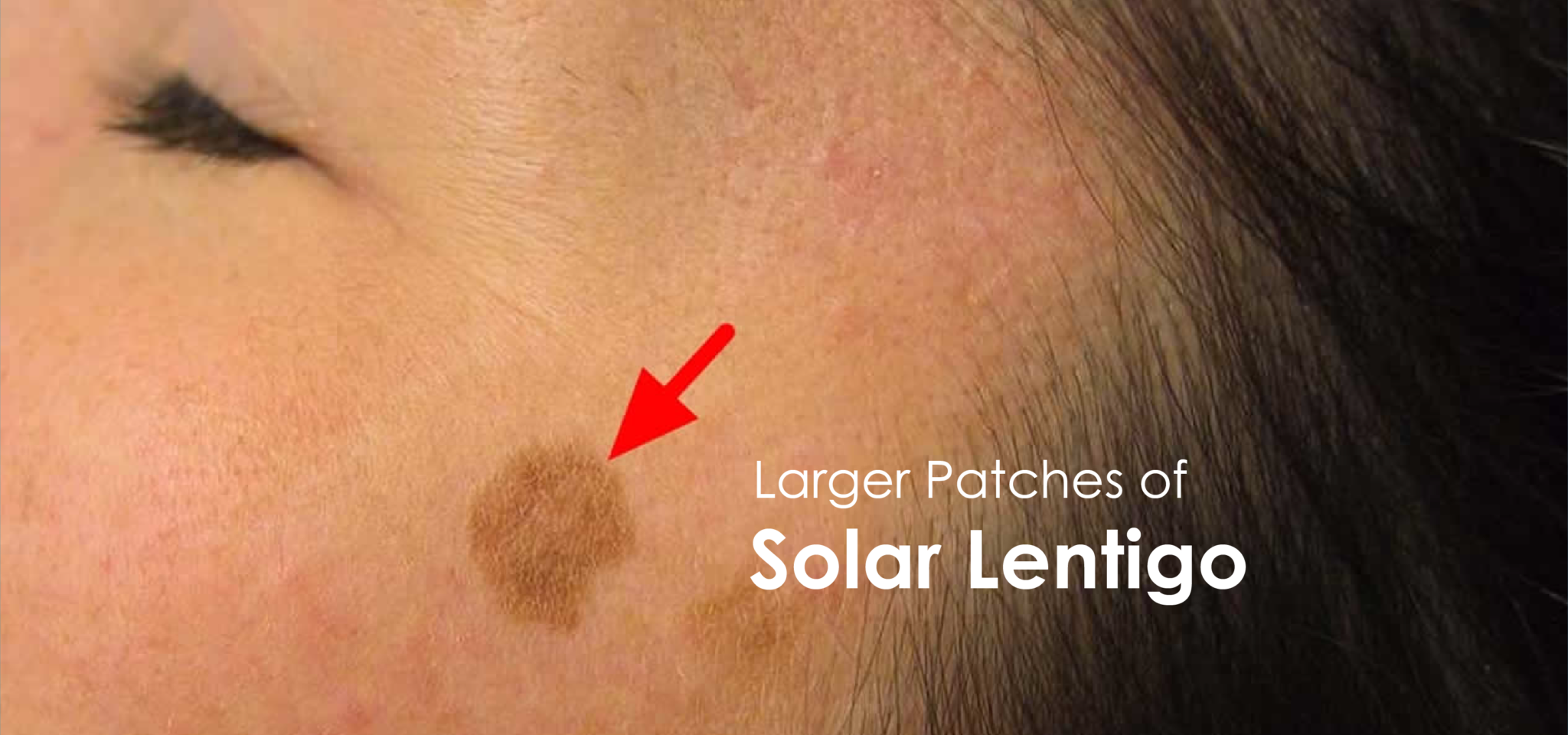 What you need to know about Age Spot and how to treat it? - UR Klinik ...