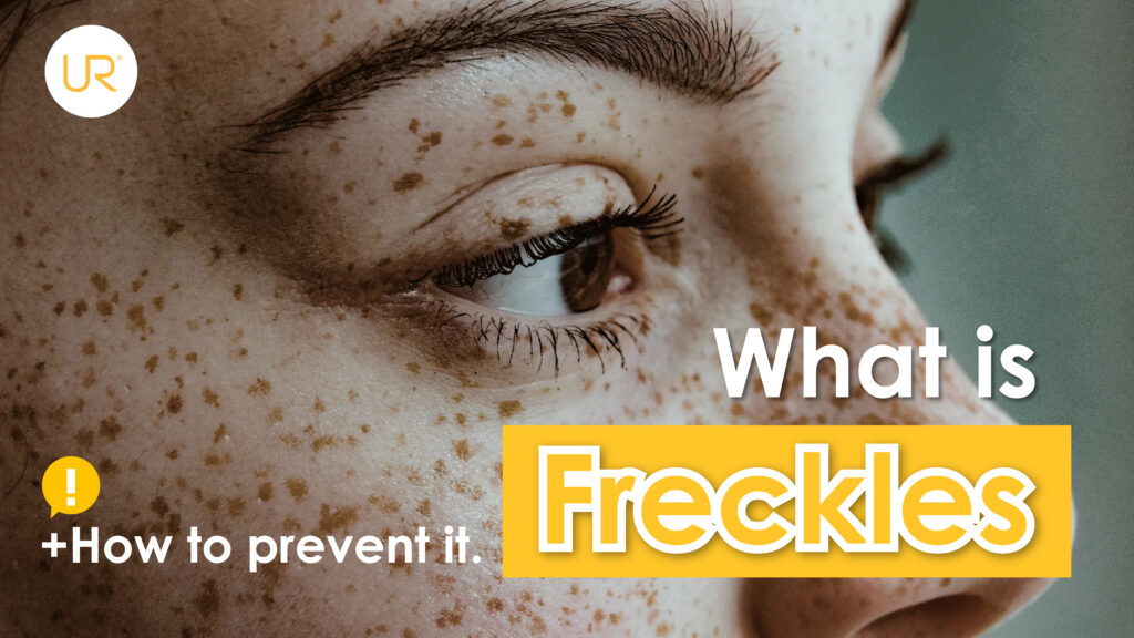 What Are Freckles And How To Prevent It And Treat It? - UR Klinik ...