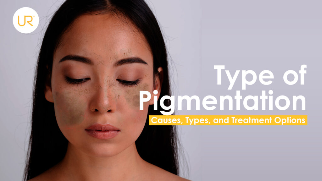 Understanding Pigmentation: Causes, Types, and Treatment Options - UR ...